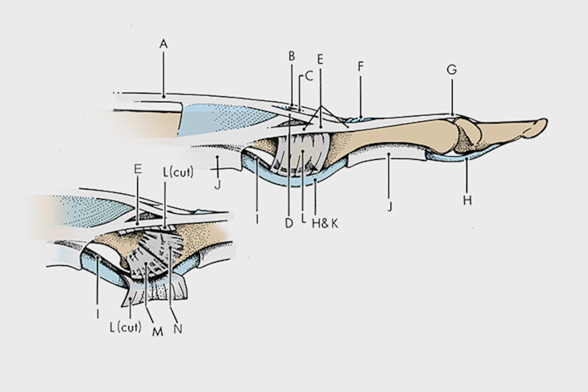 INTRINSIC TIGHTNESS (INTRINSIC CONTRACTURES) | Hand Surgery Resource